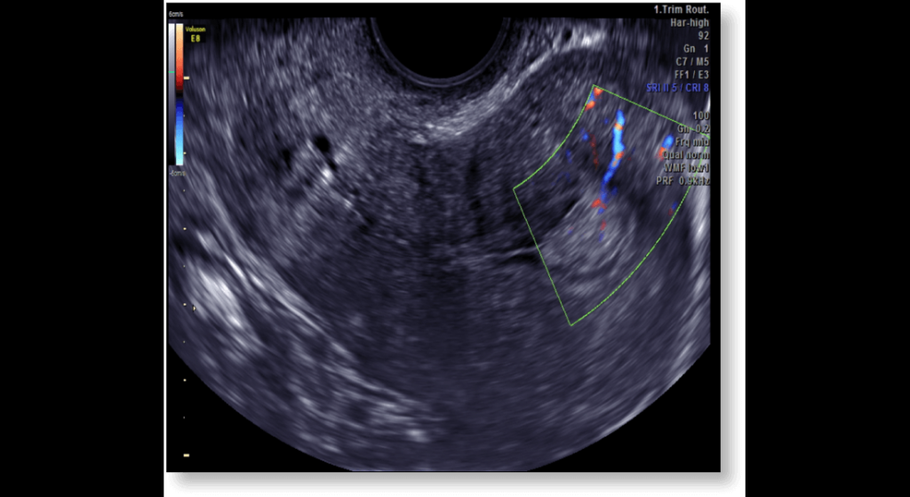 Gynekologický ultrazvuk | Sonoclinic Košice